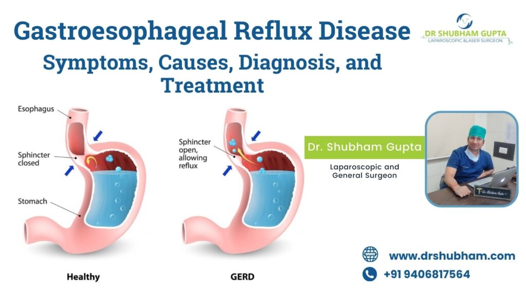 Gastroesophageal Reflux Disease Symptoms Causes Diagnosis And